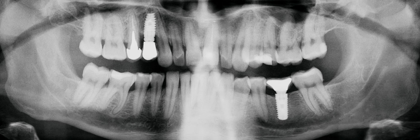 Multiple Tooth Implants – AlpiSmile